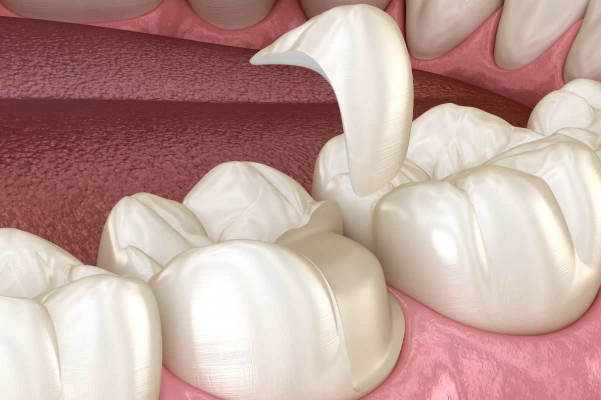 Cracked Tooth vs. Cavity: Key Differences & Treatment Options