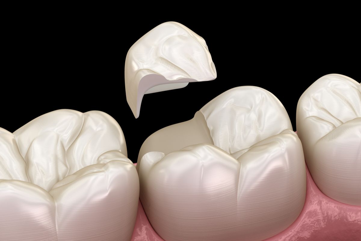 Repair Your Dental Crown in McMurray, PA