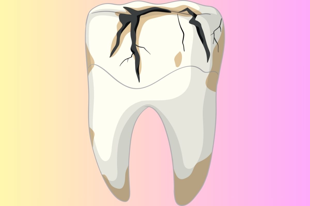 Cracked Tooth Syndrome: Symptoms, Causes, and Treatment