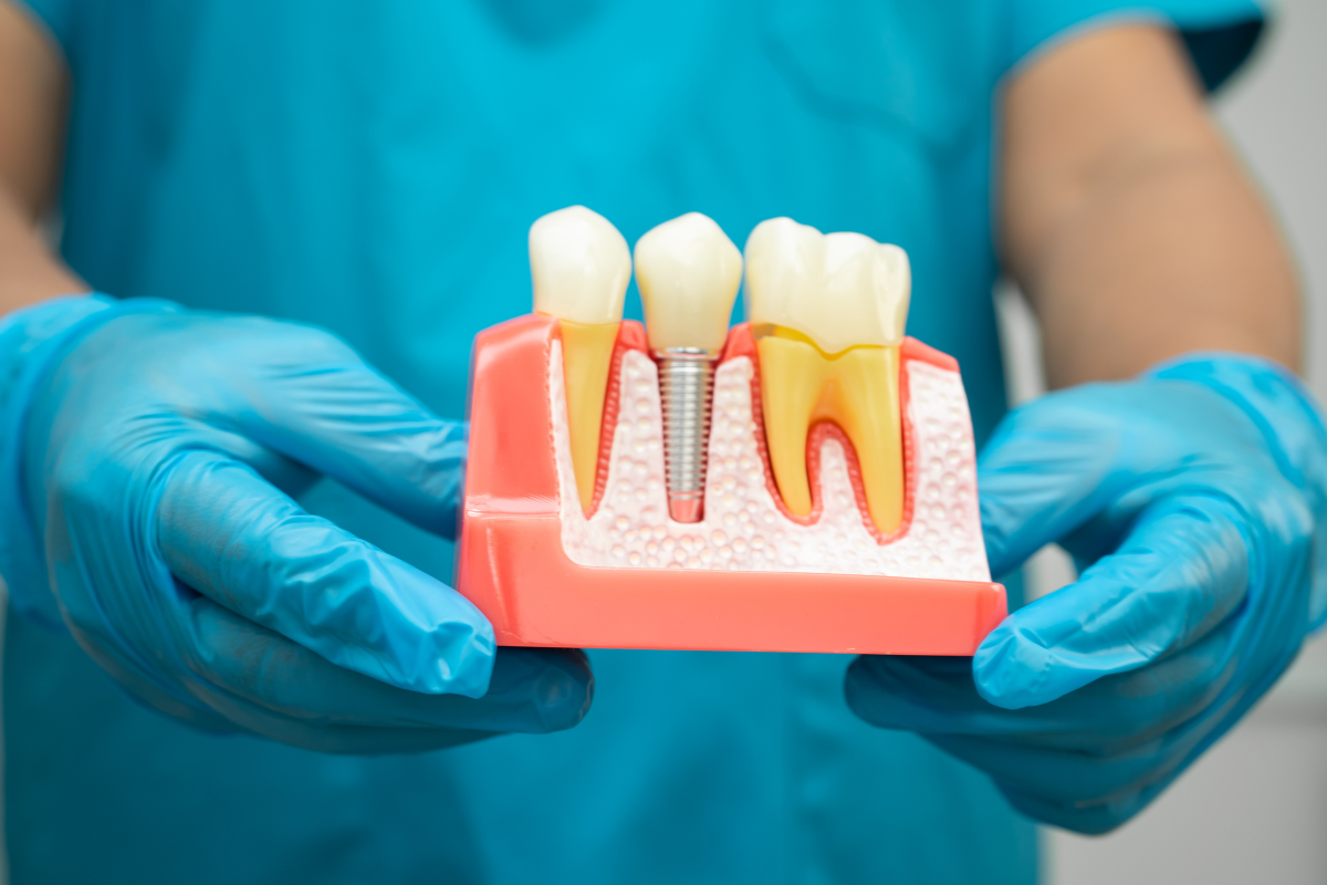 Dental Implants Explained: Permanent Tooth Replacement